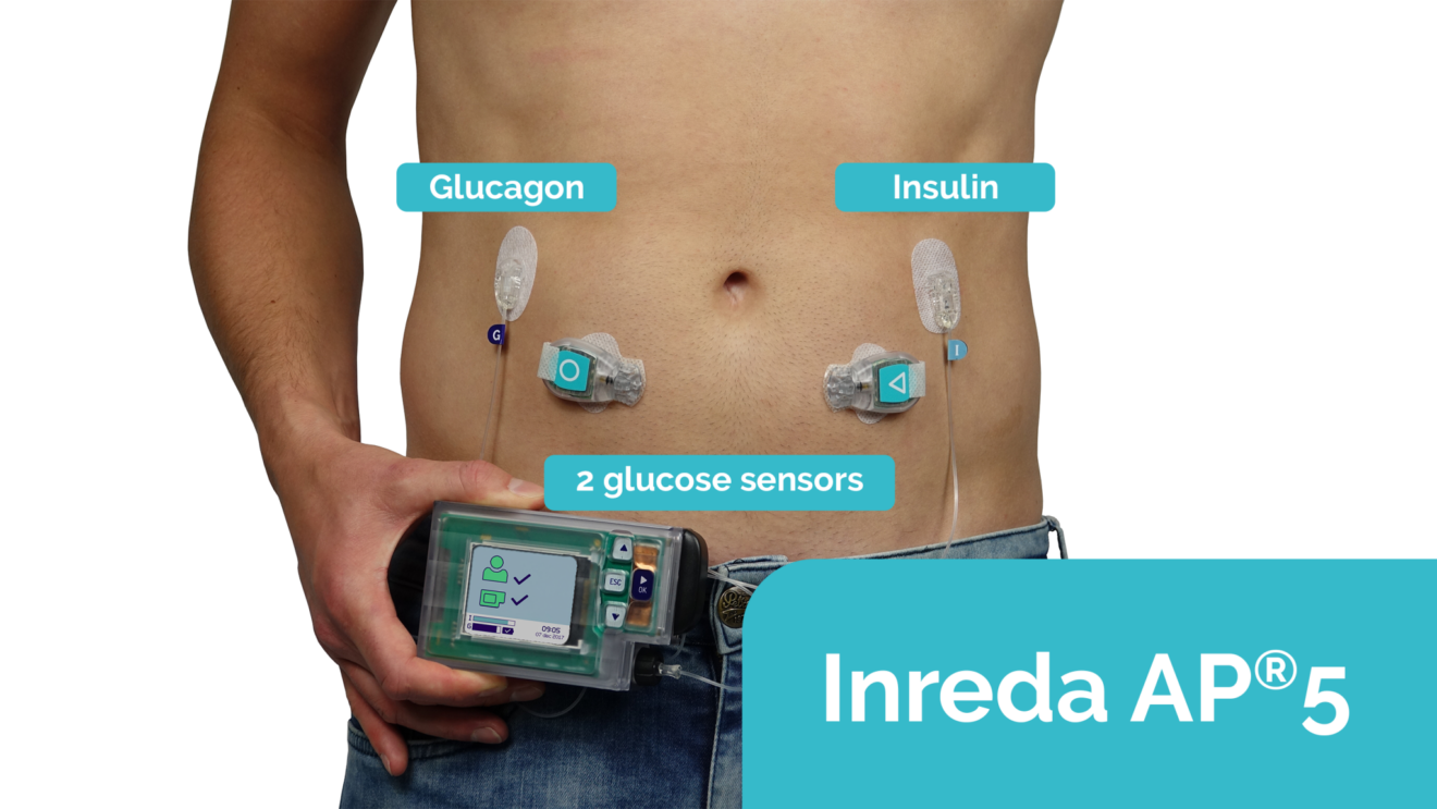 Conheça o verdadeiro Pâncreas Artificial - Clube do Diabetes